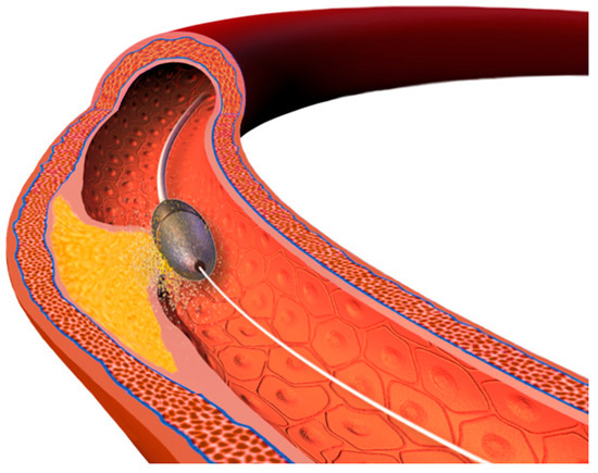 The Significance of Coronary Artery Calcification for Percutaneous Coronary Interventions