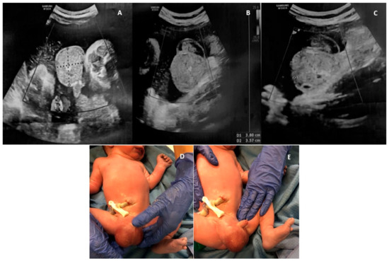 Healthcare Free Full Text Inguinoscrotal Hernia A Possible Cause