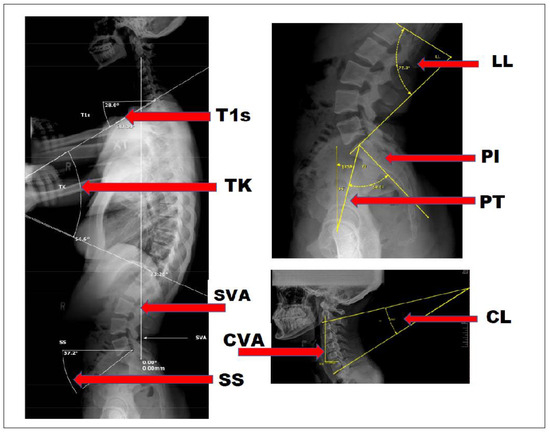 Plain Radiography: A Unique Component of Spinal Assessment and ...