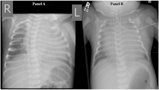 Vein of Galen Aneurysmal Malformation: A Case Report