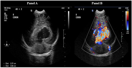 Vein of Galen Aneurysmal Malformation: A Case Report