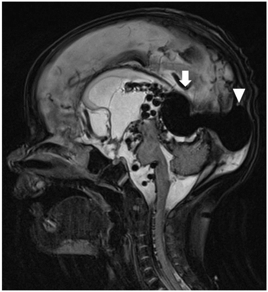 Vein of Galen Aneurysmal Malformation: A Case Report
