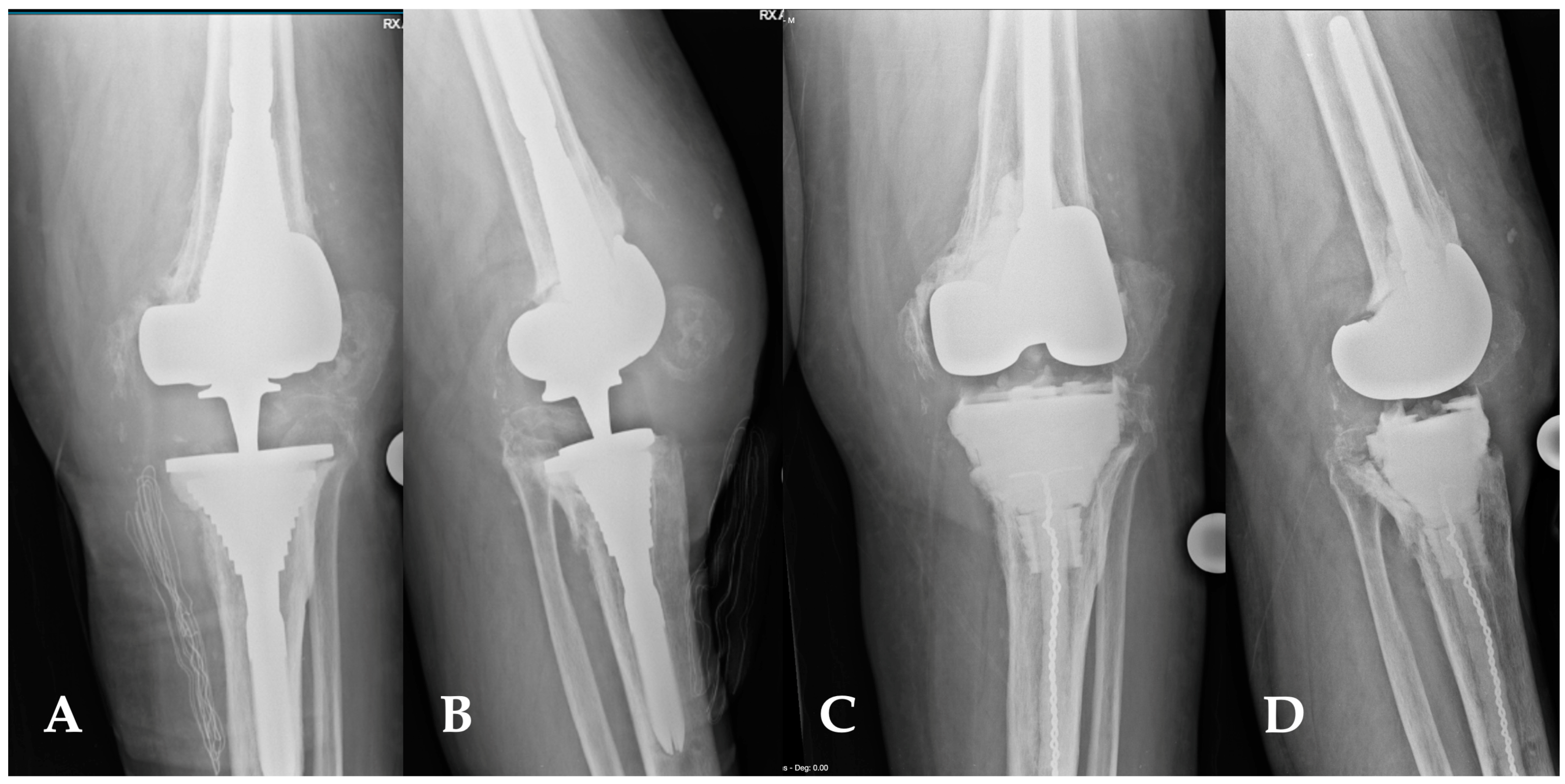Augmented Articulating Spacers in Infected Total Knee Arthroplasty ...
