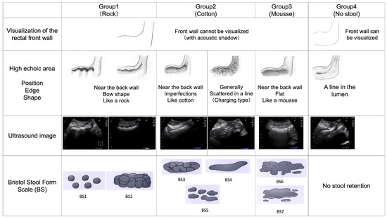 Evaluating Accuracy of Rectal Fecal Stool Assessment Using Transgluteal ...