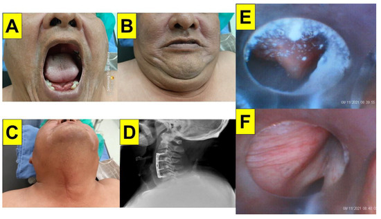 Healthcare | Free Full-Text | Structured Routine Use of Styletubation ...