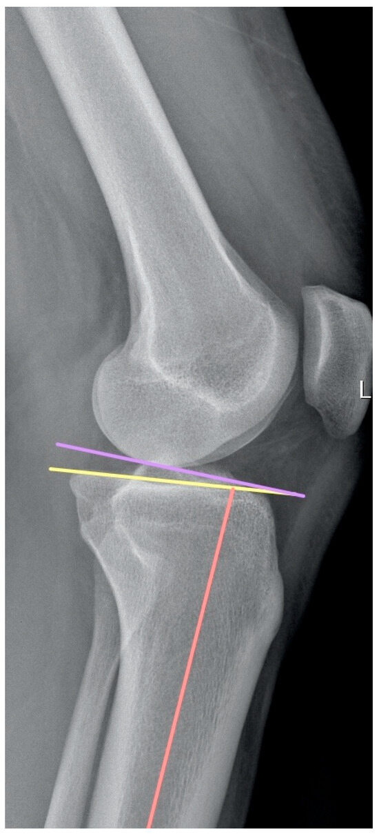 Posterior Cruciate Buckling Angle Variations Are Associated with ...