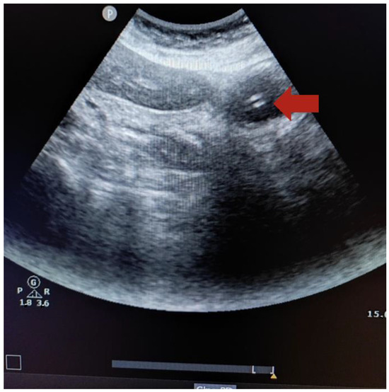Verification of Nasogastric Tube Positioning Using Ultrasound by an ...