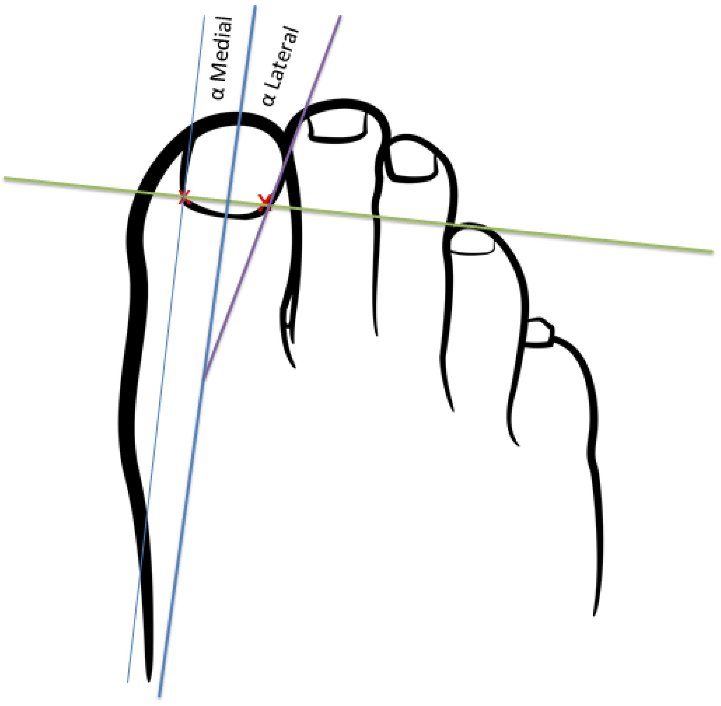 Deviation of the Nail Lamina after Unilateral Partial Matricectomy