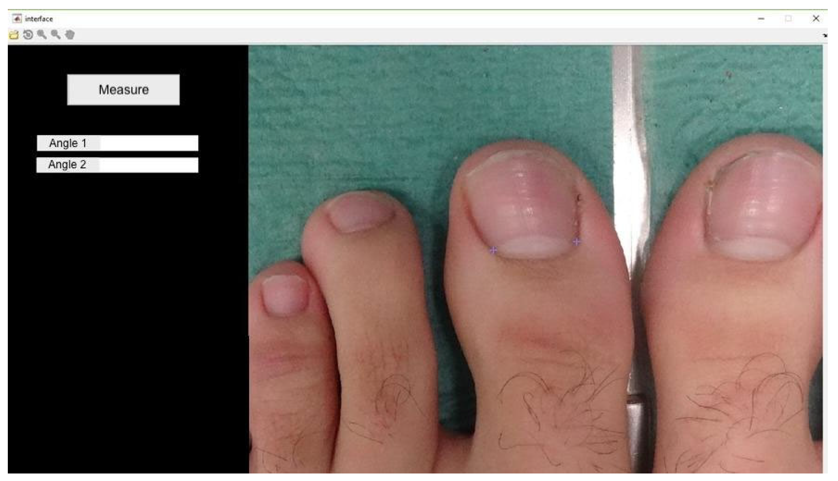 Deviation of the Nail Lamina after Unilateral Partial Matricectomy