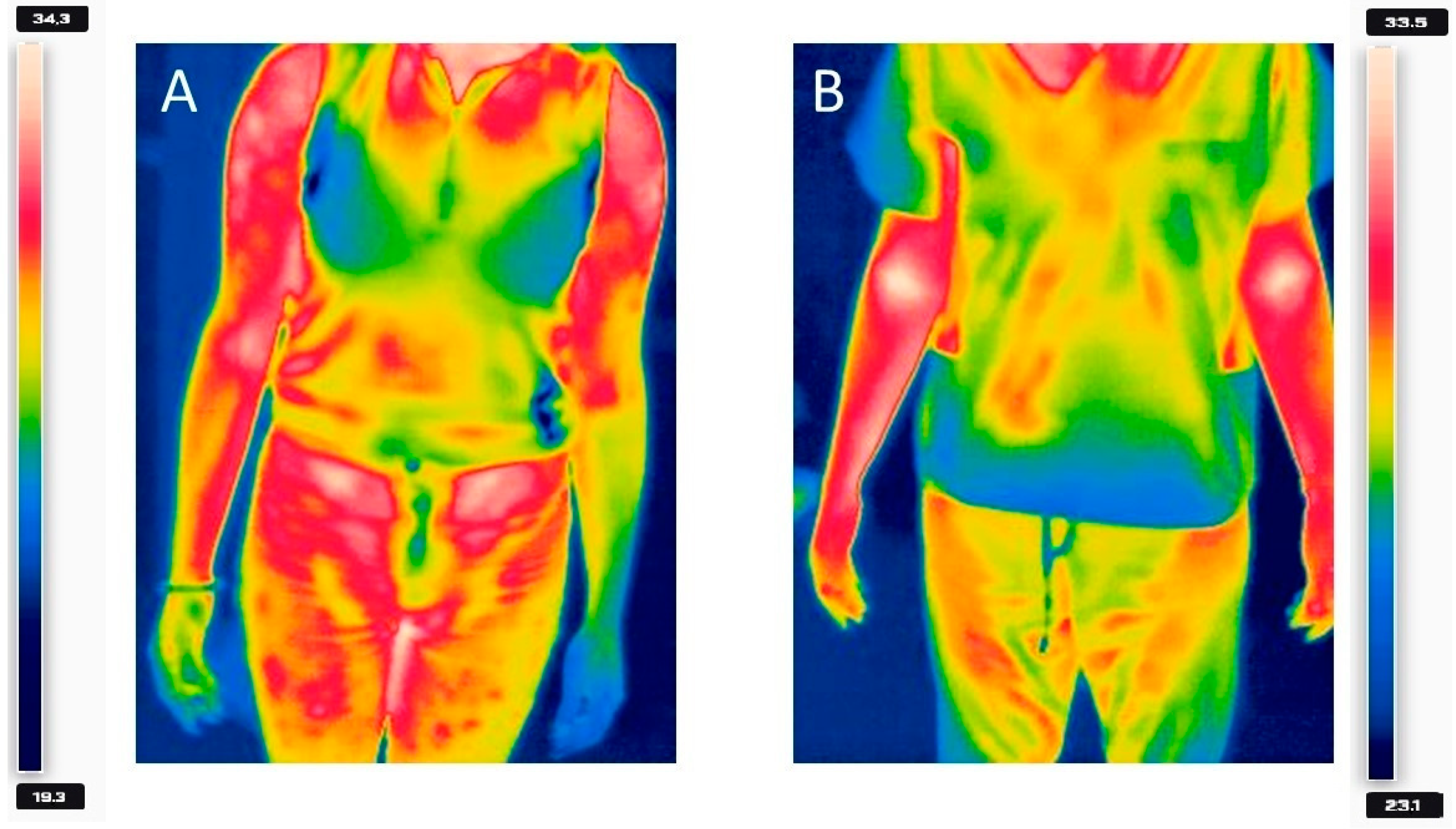 Arterial Thoracic Outlet Syndrome—A Case Study of a 23-Year-Old Female ...