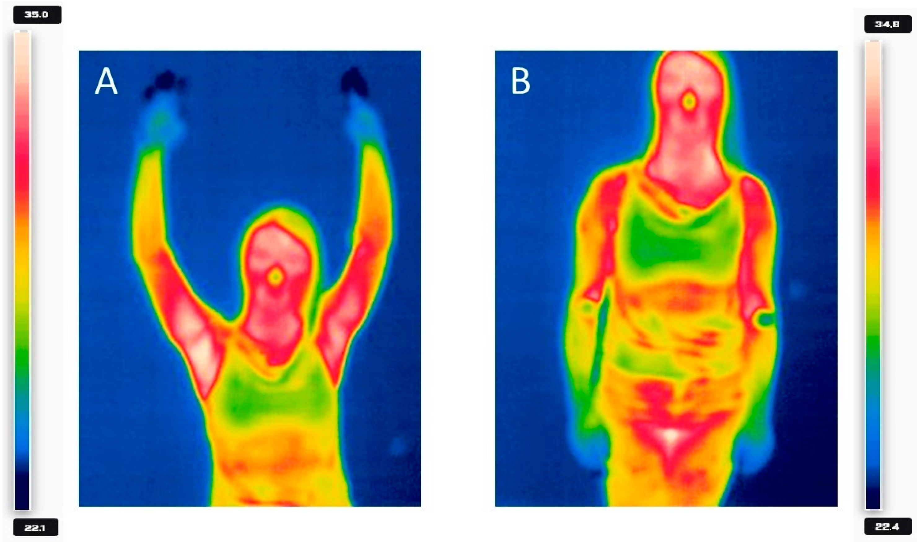 Arterial Thoracic Outlet Syndrome—A Case Study of a 23-Year-Old Female ...