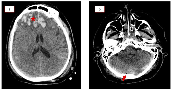 Post-Traumatic Cerebral Venous Sinus Thrombosis (PtCVST) Resulting in ...