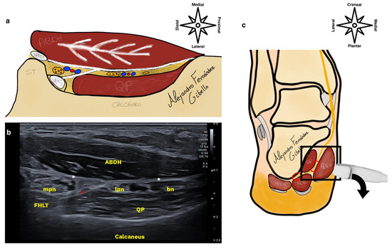 Ultrasound-Guided Approach to the Distal Tarsal Tunnel: Implications ...