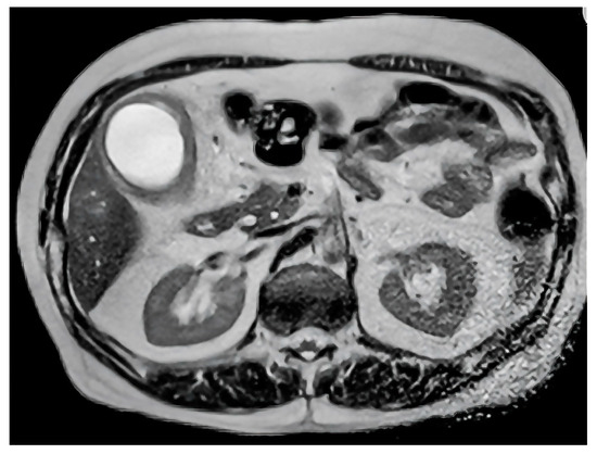 Xanthogranulomatous Cholecystitis: A Retrospective Review of Clinical ...