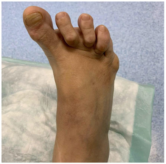 Iatrogenic Hallux Varus in a Patient with Rheumatoid Arthritis
