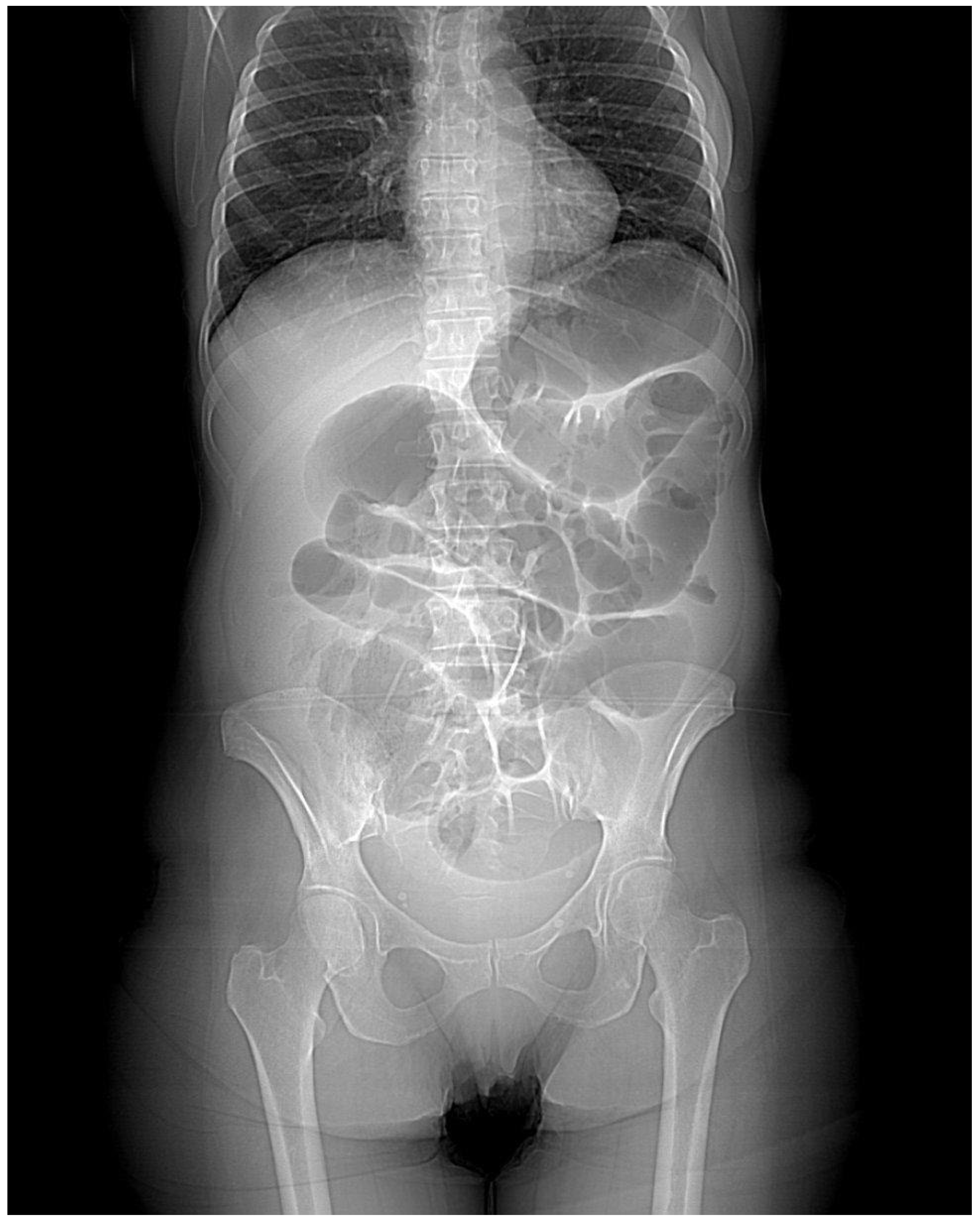 Pelvic Actinomycosis and Diagnostic Complexity: Case Report with ...