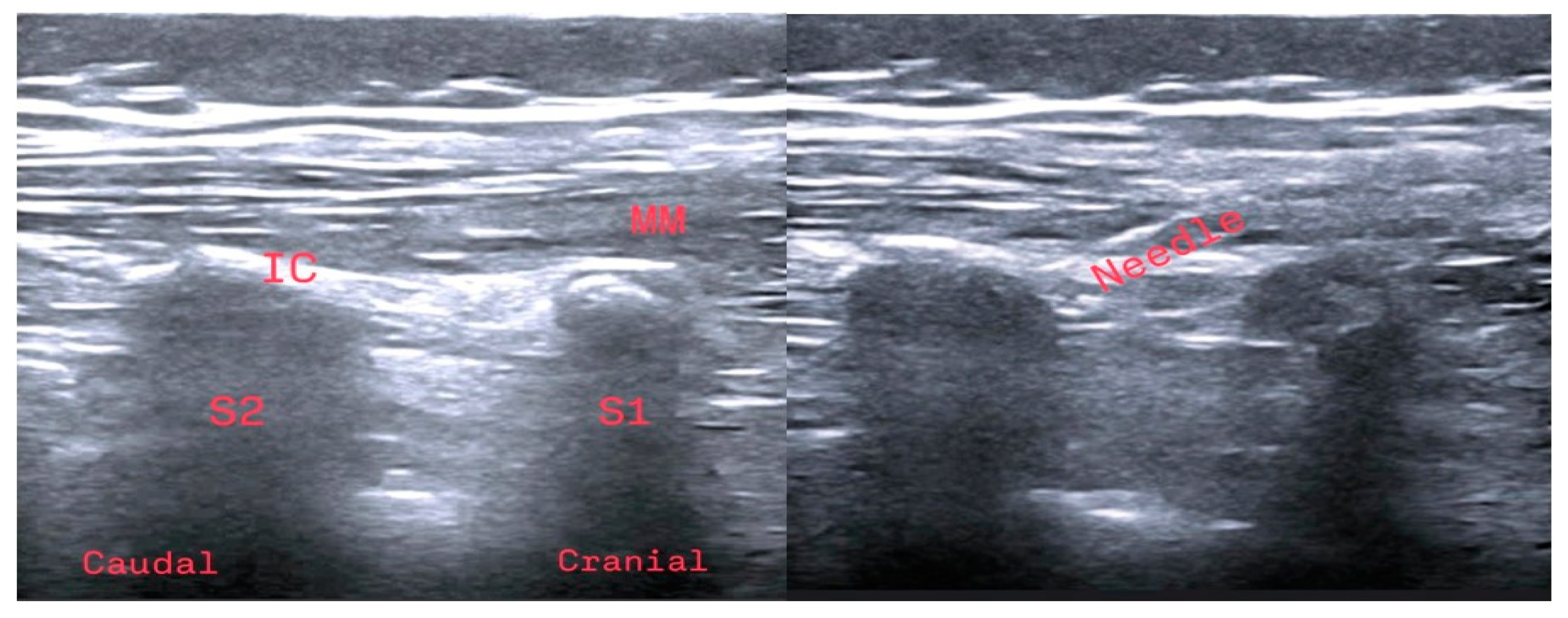 Comparison of Sacral Erector Spinae Plane Block vs. Ring Block for ...