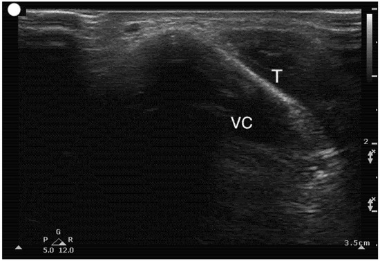 Airway Ultrasound: A Narrative Review of Present Use and Future ...