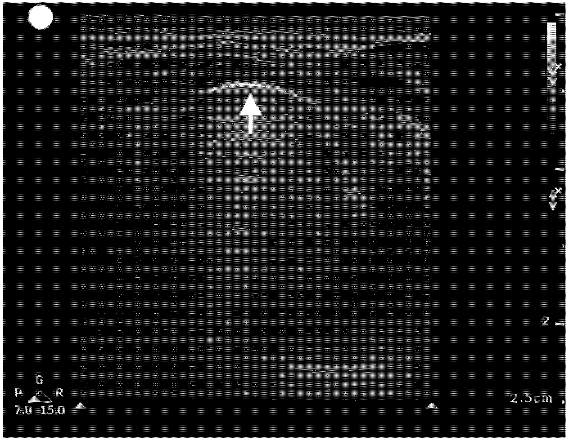 Airway Ultrasound: A Narrative Review of Present Use and Future ...