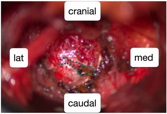 Bertolotti Syndrome: Surgical Treatment in a Middle-Aged Triathlete—A ...