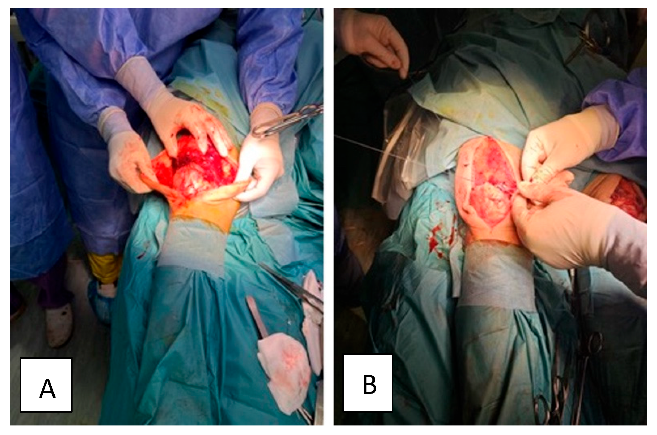 Tailored Rehabilitation Program and Dynamic Ultrasonography After ...