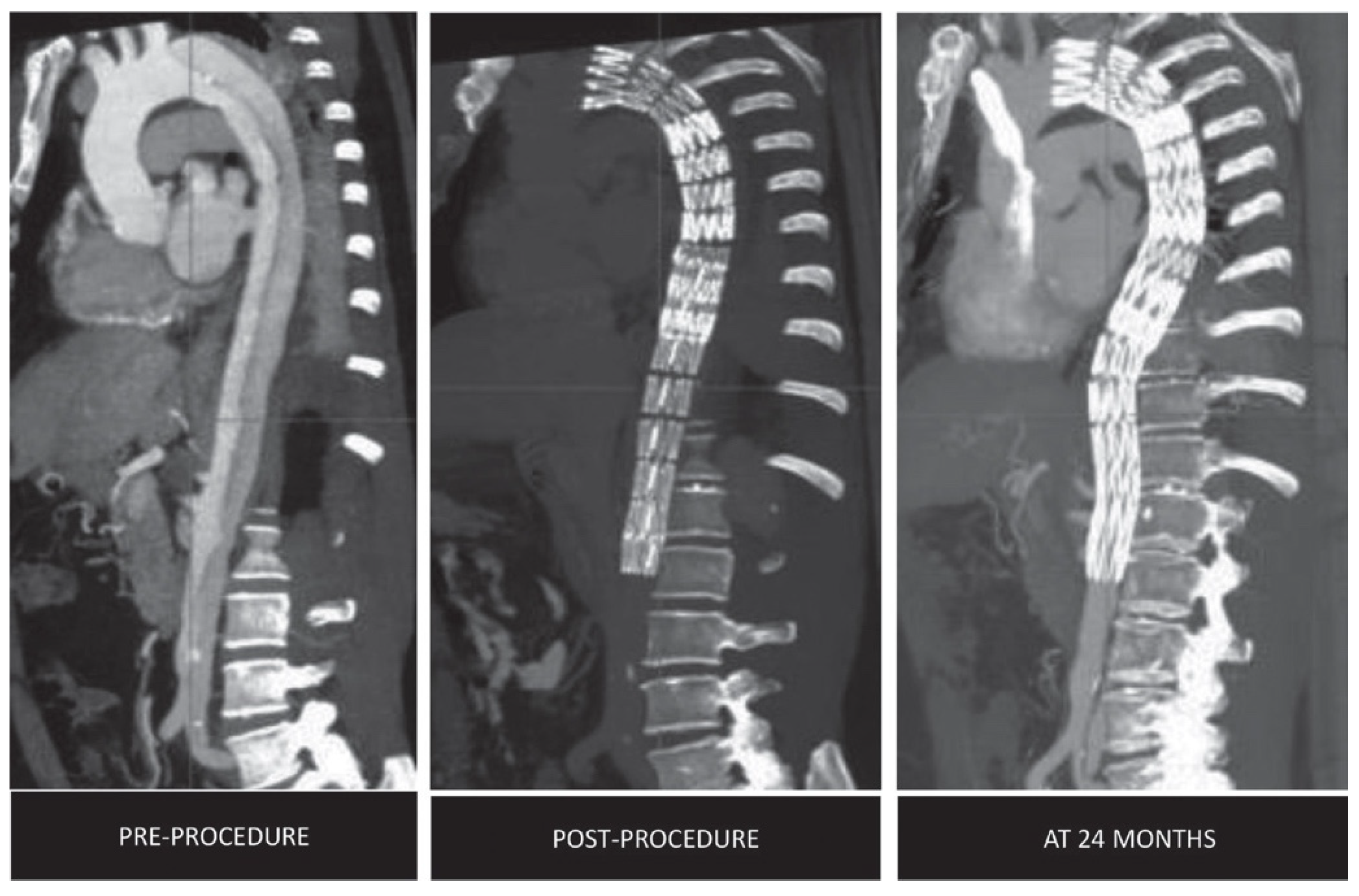 Hearts Free Full Text Management Of Uncomplicated Type B Aortic