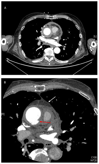 A Review on the Surgical Management of Intramural Haematoma of the Aorta