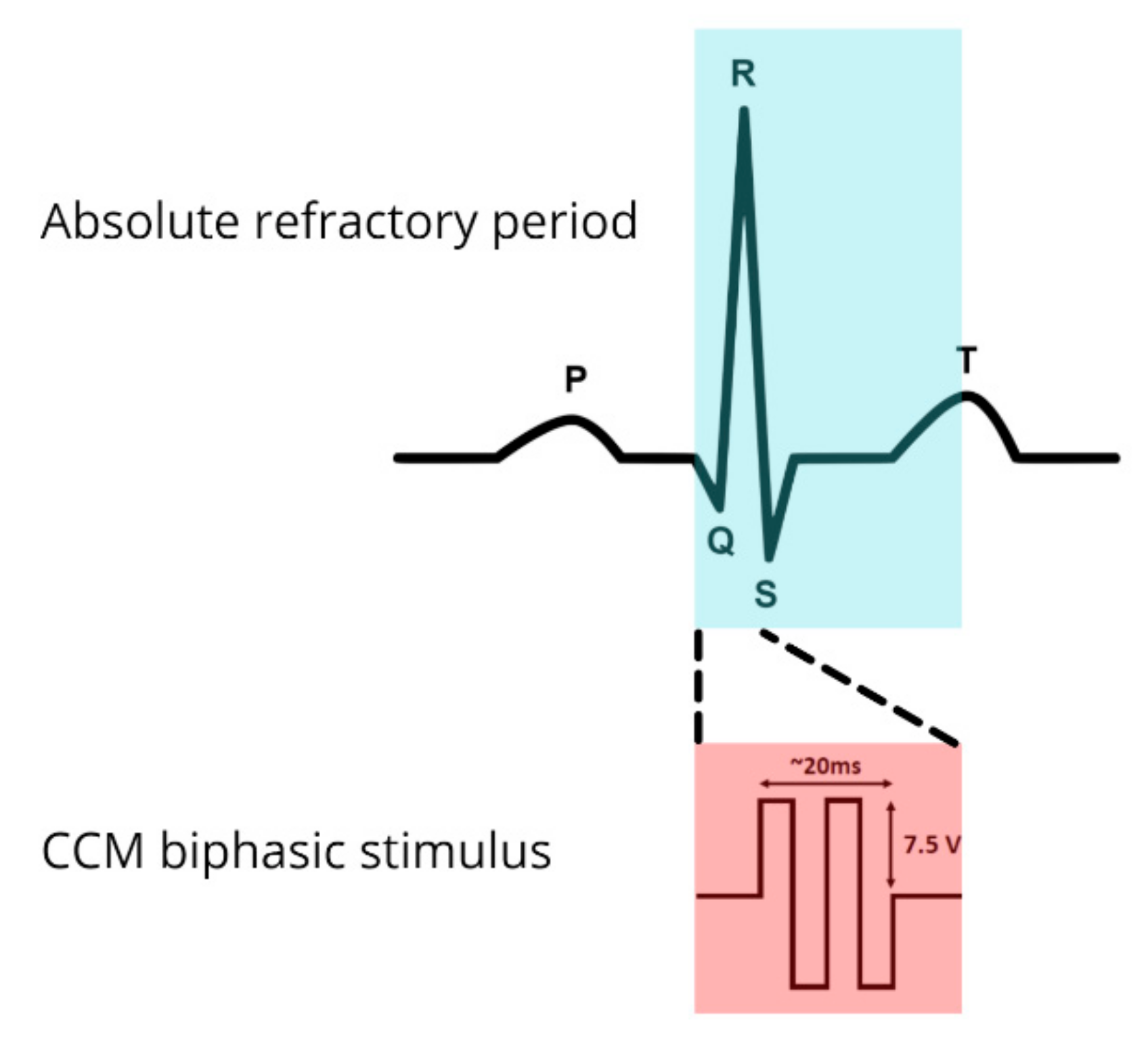Cardiac Contractility Modulation in Patients with Heart Failure with ...