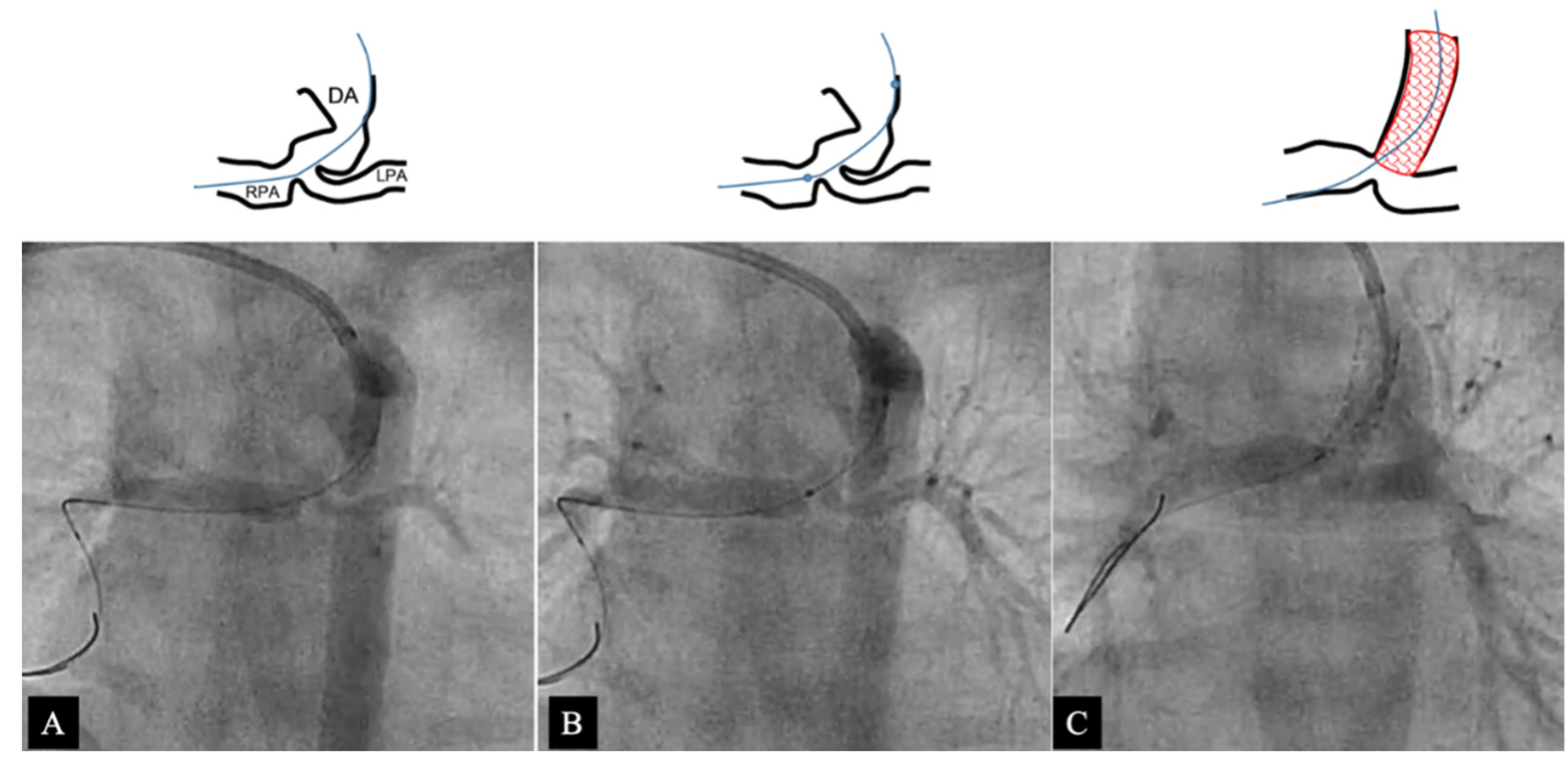 Technical Modifications for Ductal Stenting in Neonates with Duct ...