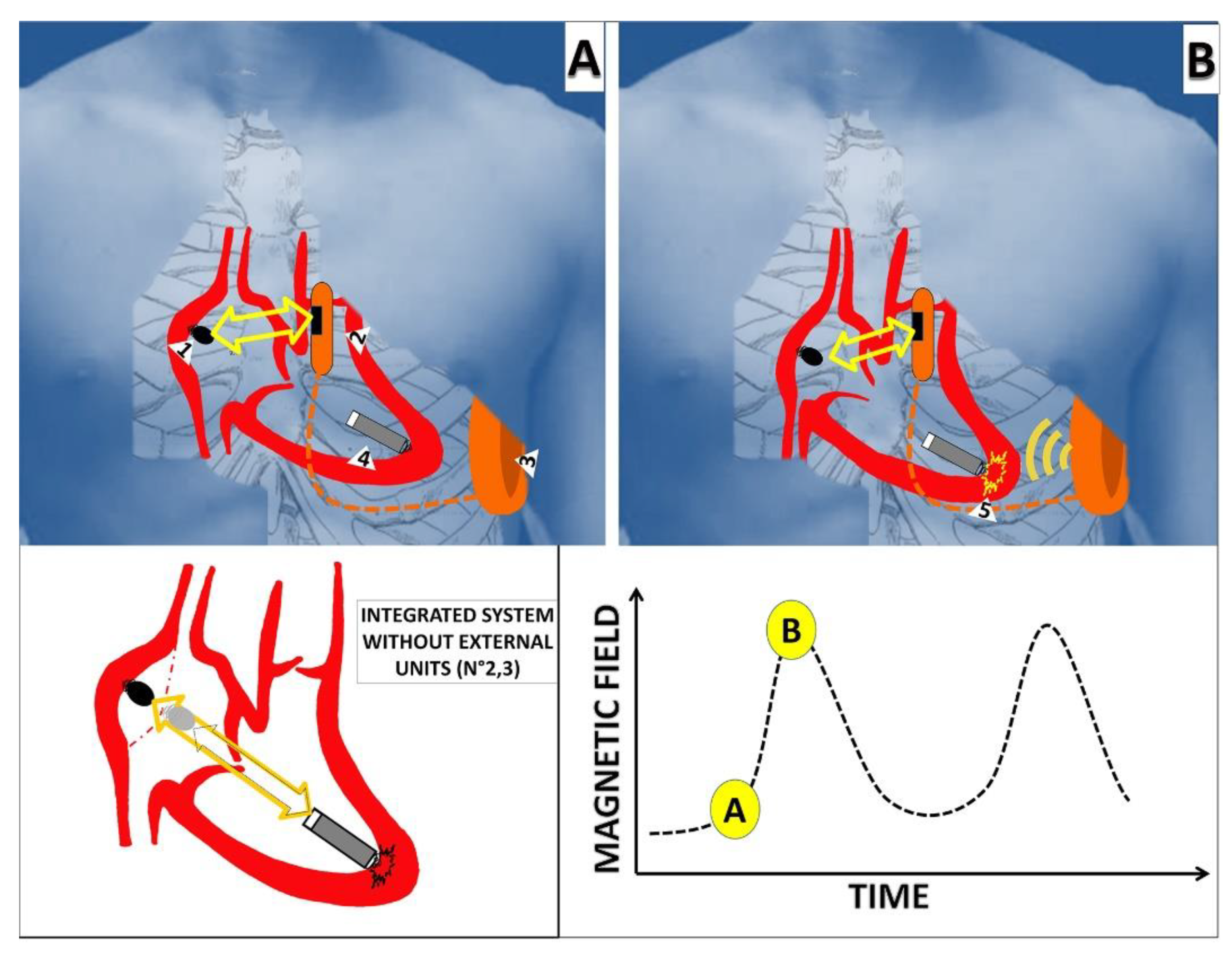 A Historical Perspective of Cardiac Implantable Electronic Device ...