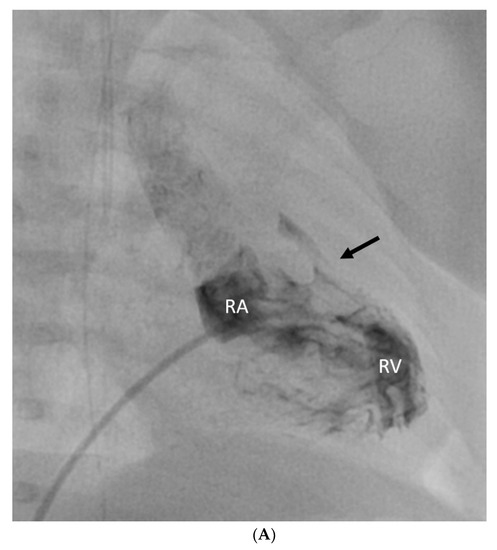 Right Ventricular Outflow Tract Stenting as Palliation of Critical ...