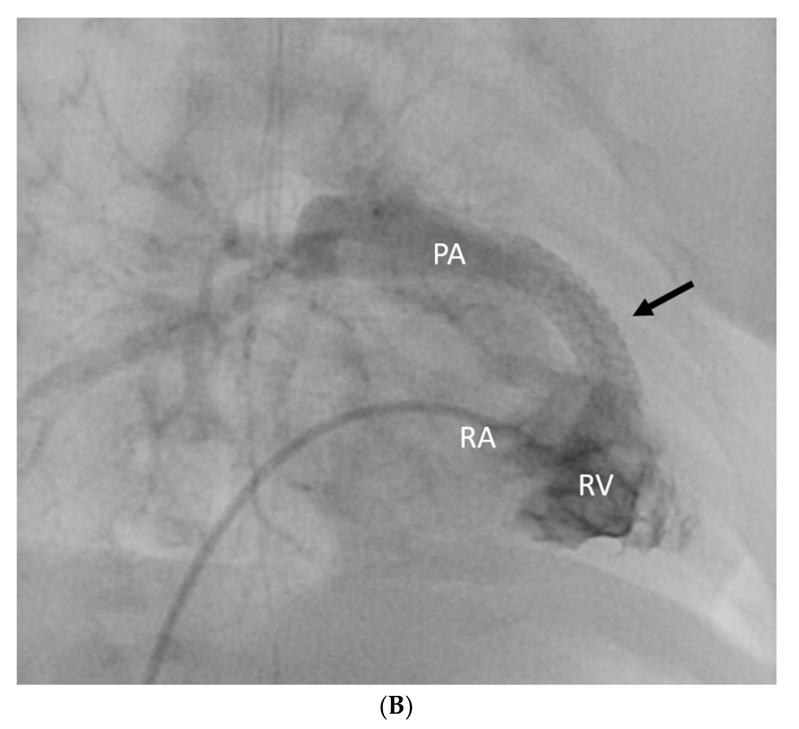 Right Ventricular Outflow Tract Stenting as Palliation of Critical ...