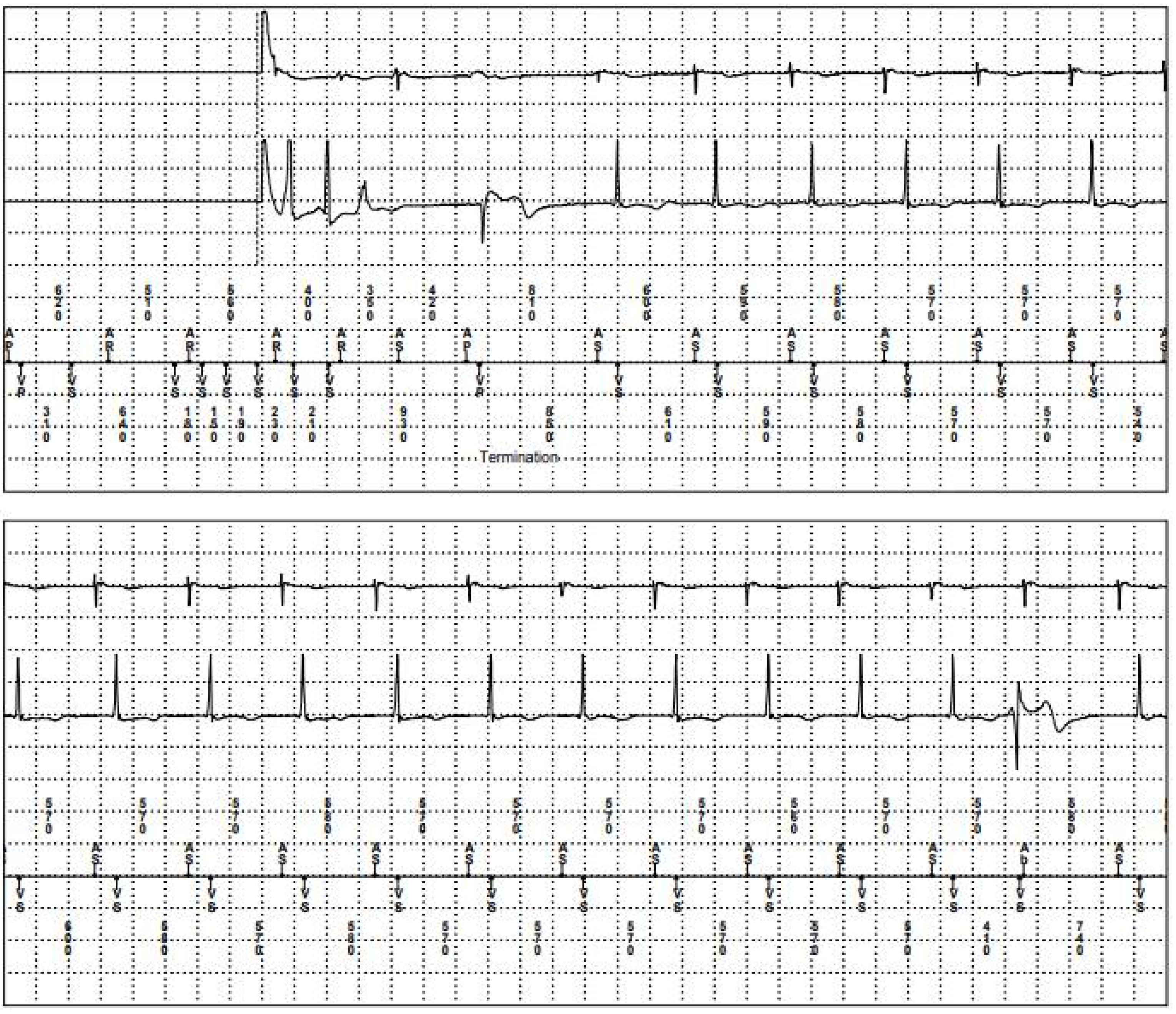 Hidden under the Surface: A Rare Cause of Repeated Syncope in a Patient ...