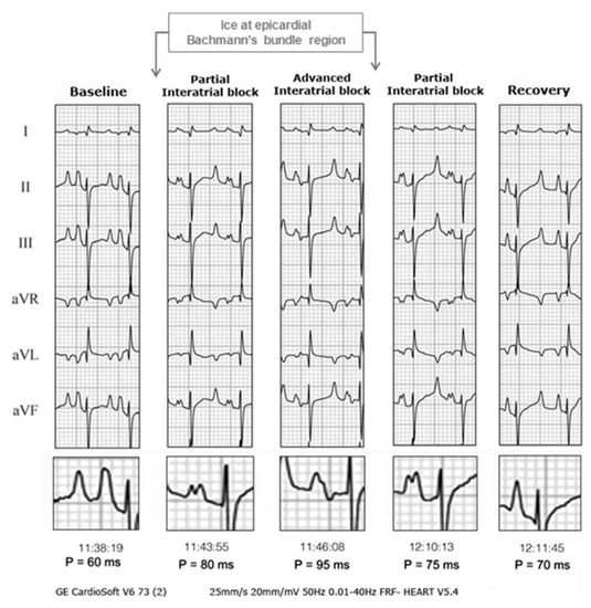 Current ECG Aspects of Interatrial Block