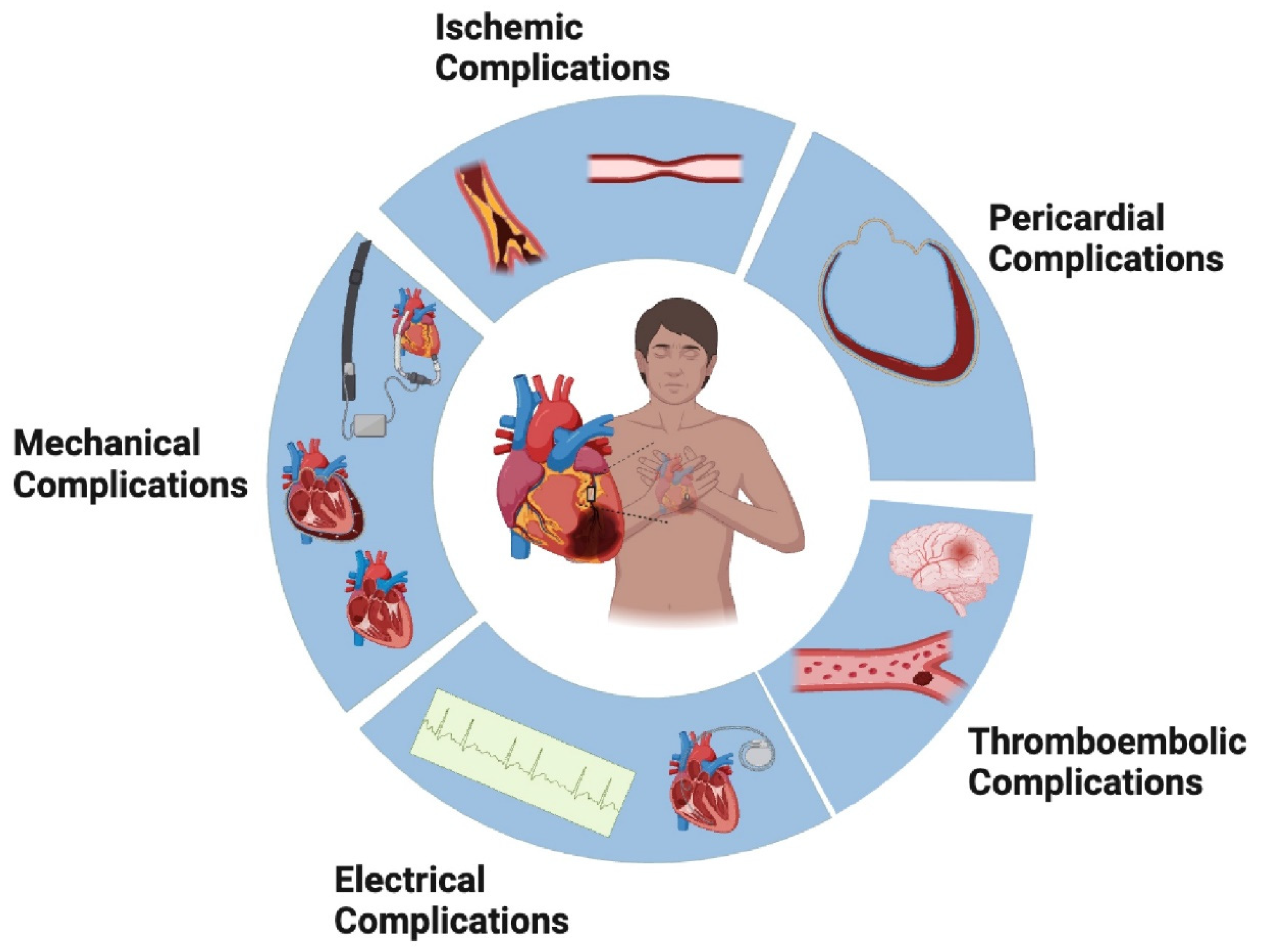 Complications In Acute Myocardial Infarction Navigating Challenges In