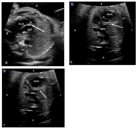 Transposition of the Great Arteries with Intramural Left Main Coronary ...