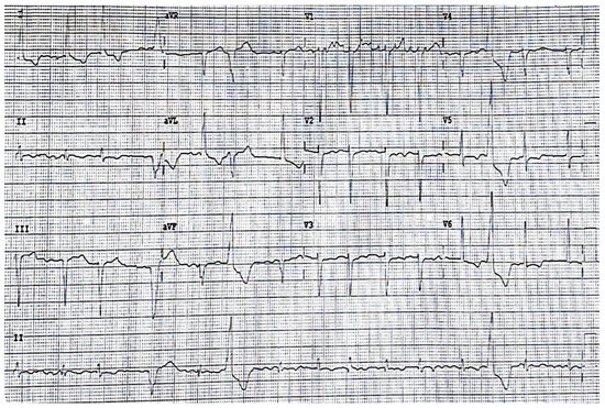 Cardiac Contractility Modulation Therapy in a Transplant Candidate ...