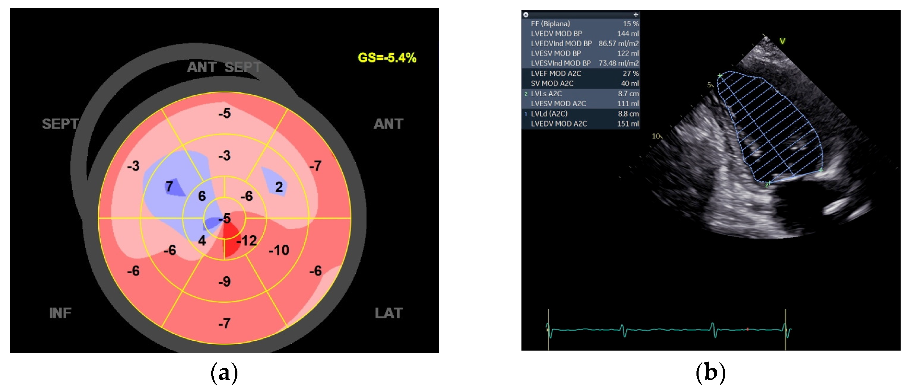 Cardiac Contractility Modulation Therapy in a Transplant Candidate ...