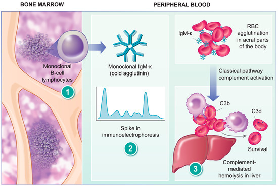 Cold Agglutinin Disease: A Distinct Clonal B-Cell Lymphoproliferative ...