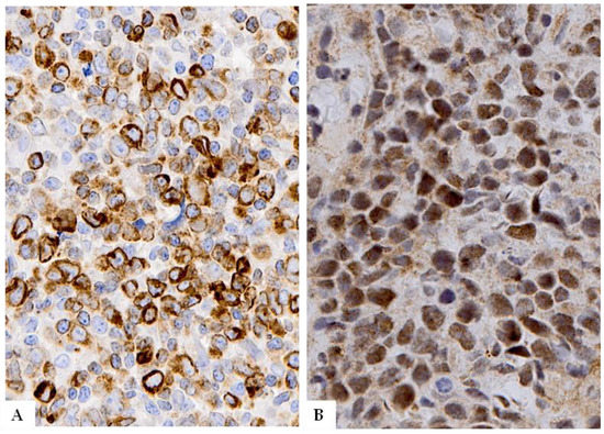 Classification of B-Cell Lymphomas and Immunodeficiency-Related Lymphoproliferations: What’s New?
