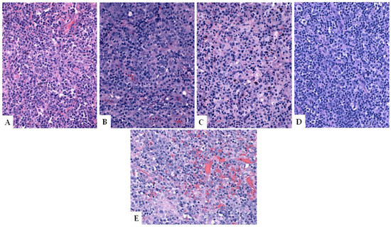 Classification of B-Cell Lymphomas and Immunodeficiency-Related Lymphoproliferations: What’s New?
