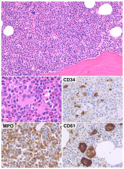 What’s New in the Classification, Diagnosis and Therapy of Myeloid ...