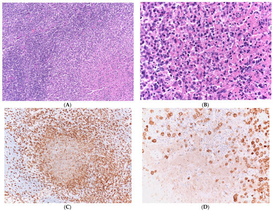 Increased Expression of CD169 on Monocytes in Adult-Onset Kikuchi ...