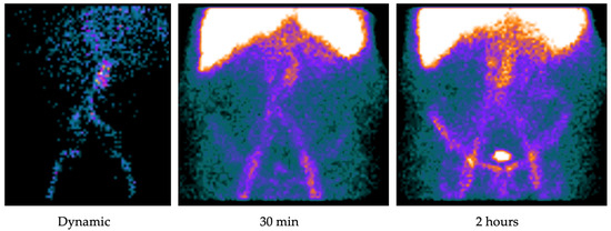 Hemato | Free Full-Text | Imaging of Vascular Graft/Endograft Infection ...