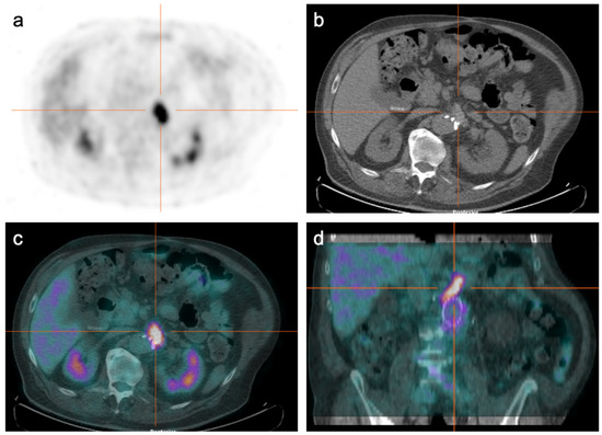 Hemato | Free Full-Text | Imaging of Vascular Graft/Endograft Infection ...