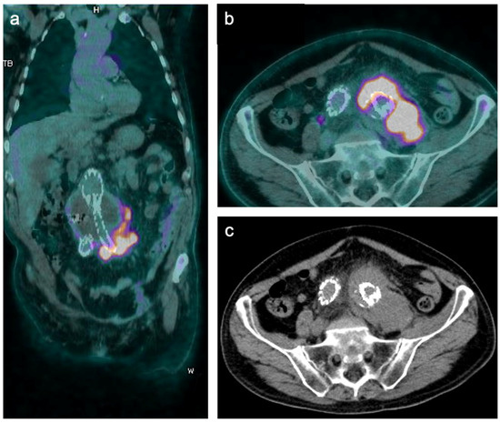 Hemato | Free Full-Text | Imaging of Vascular Graft/Endograft Infection ...