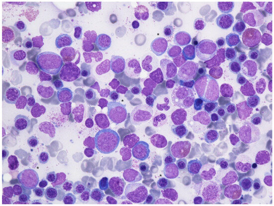 Transient Leukoerythroblastosis Unmasking Clonal Hematopoiesis with ...