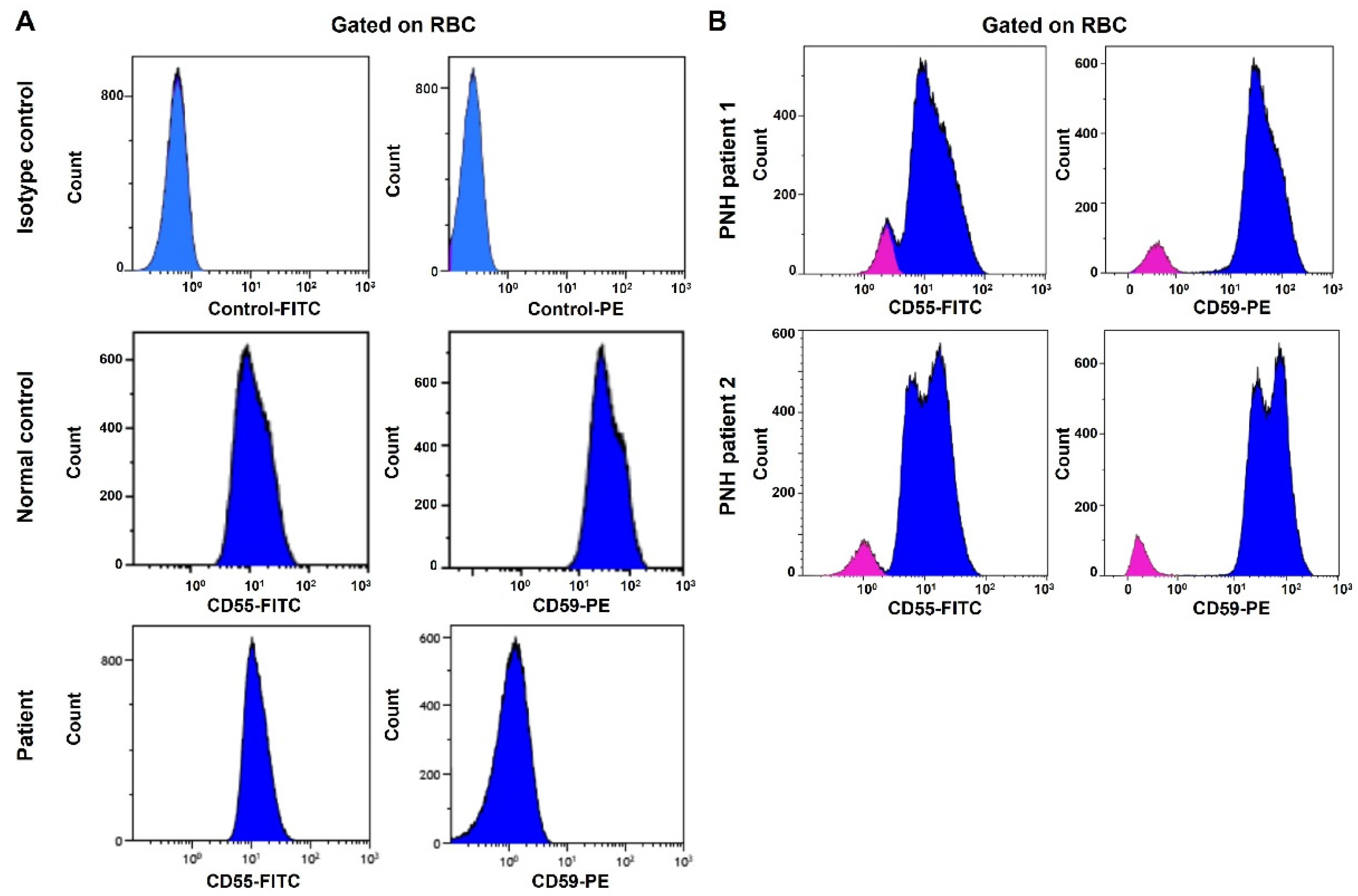 A Splice Site Mutation Associated with Congenital CD59 Deficiency