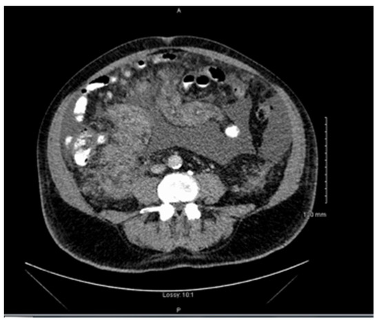 An Isolated Mesenteric Presentation of a Nodal Peripheral T Cell ...
