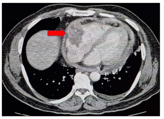Constrictive Pericarditis–A Cloak Camouflaging Lymphoma